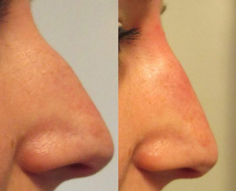 Neuscorrectie met fillers | incl. gratis intake | ABC Clinic