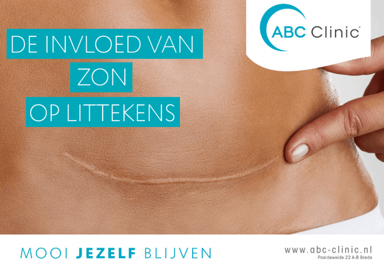 De invloed van zon op littekens | ABC Clinic