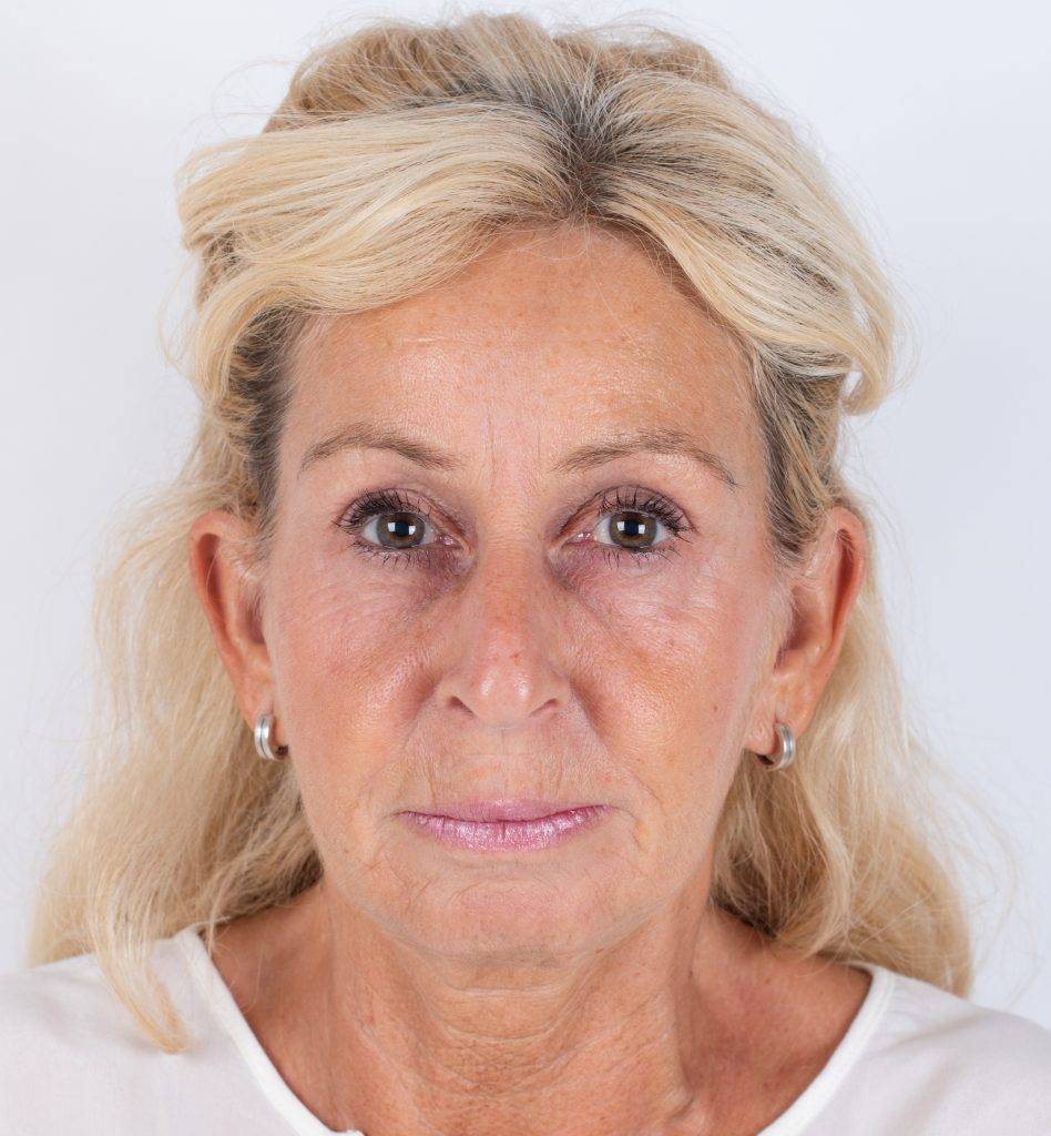 Fronsrimpel verwijderen met Botox - ervaren artsen | ABC Clinic Breda