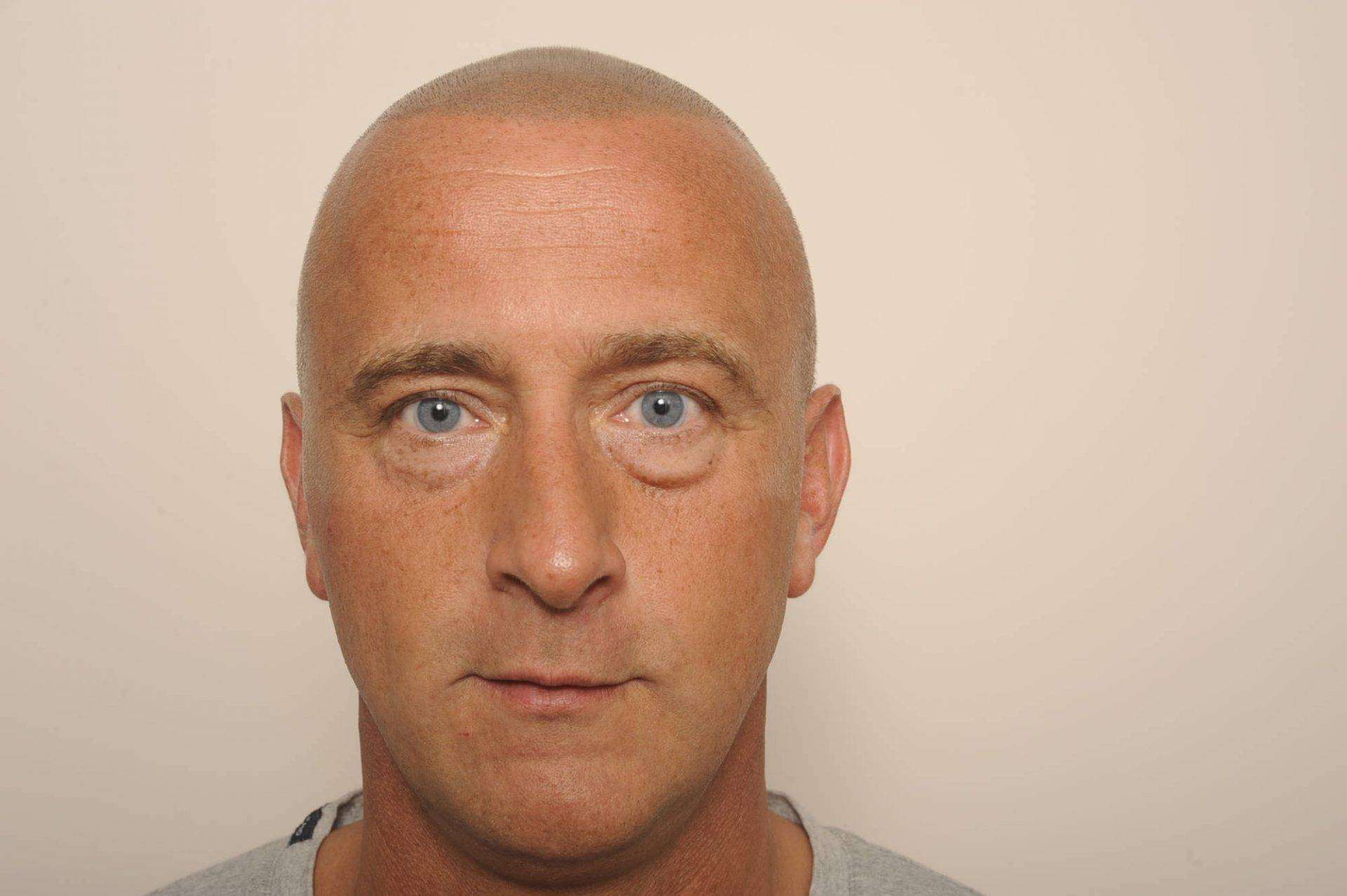 Misverstand: Vochtwallen weghalen met Botox of fillers - ABC Clinic