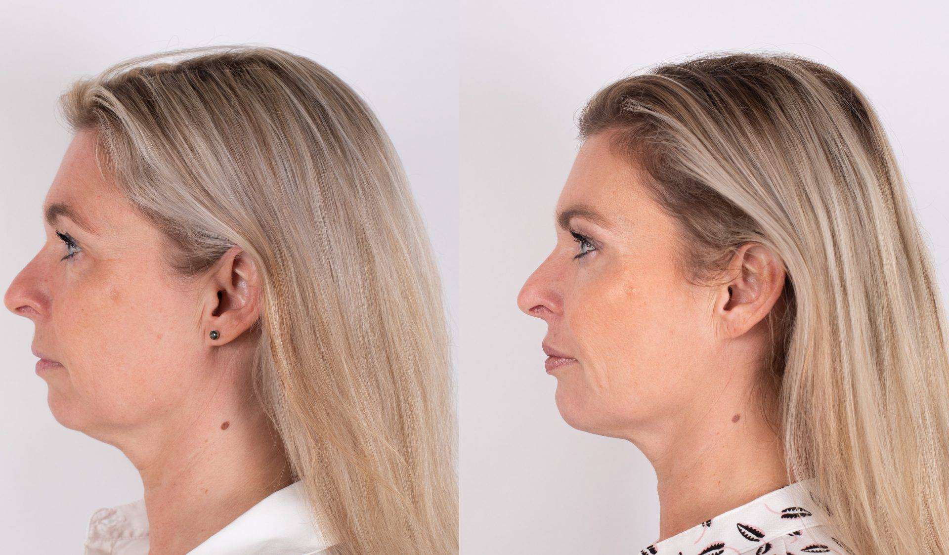 Ervaringen Botox In Kringspier - The cuddle