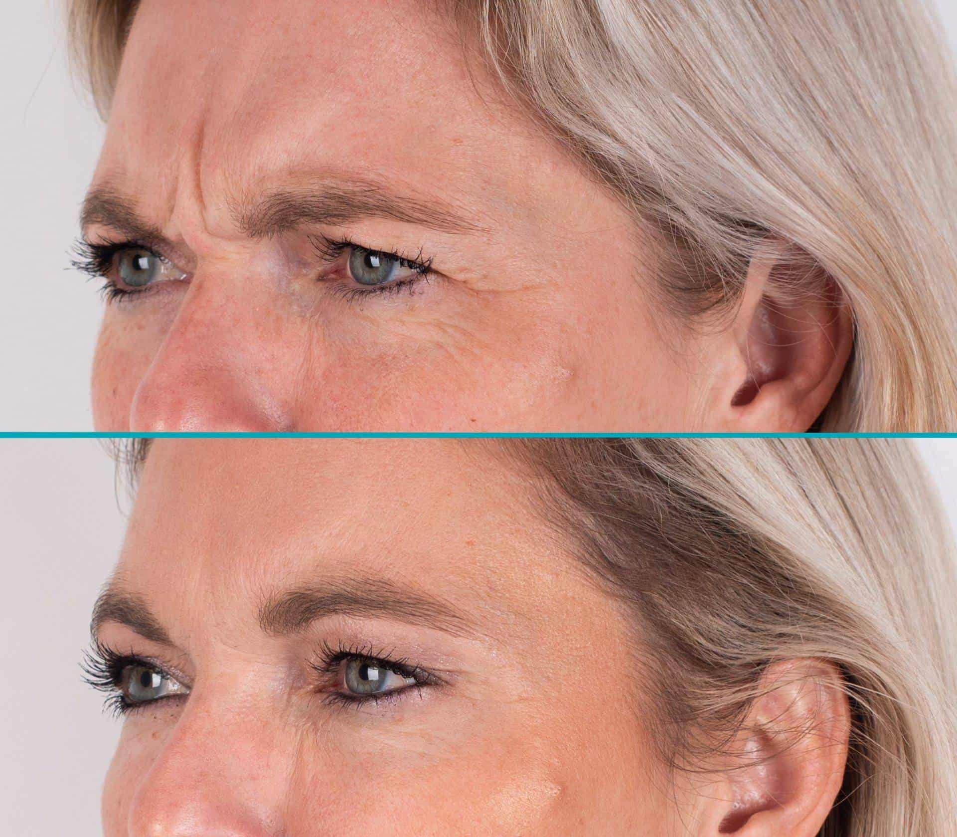 5 veelgestelde vragen over Botox in de fronsrimpel