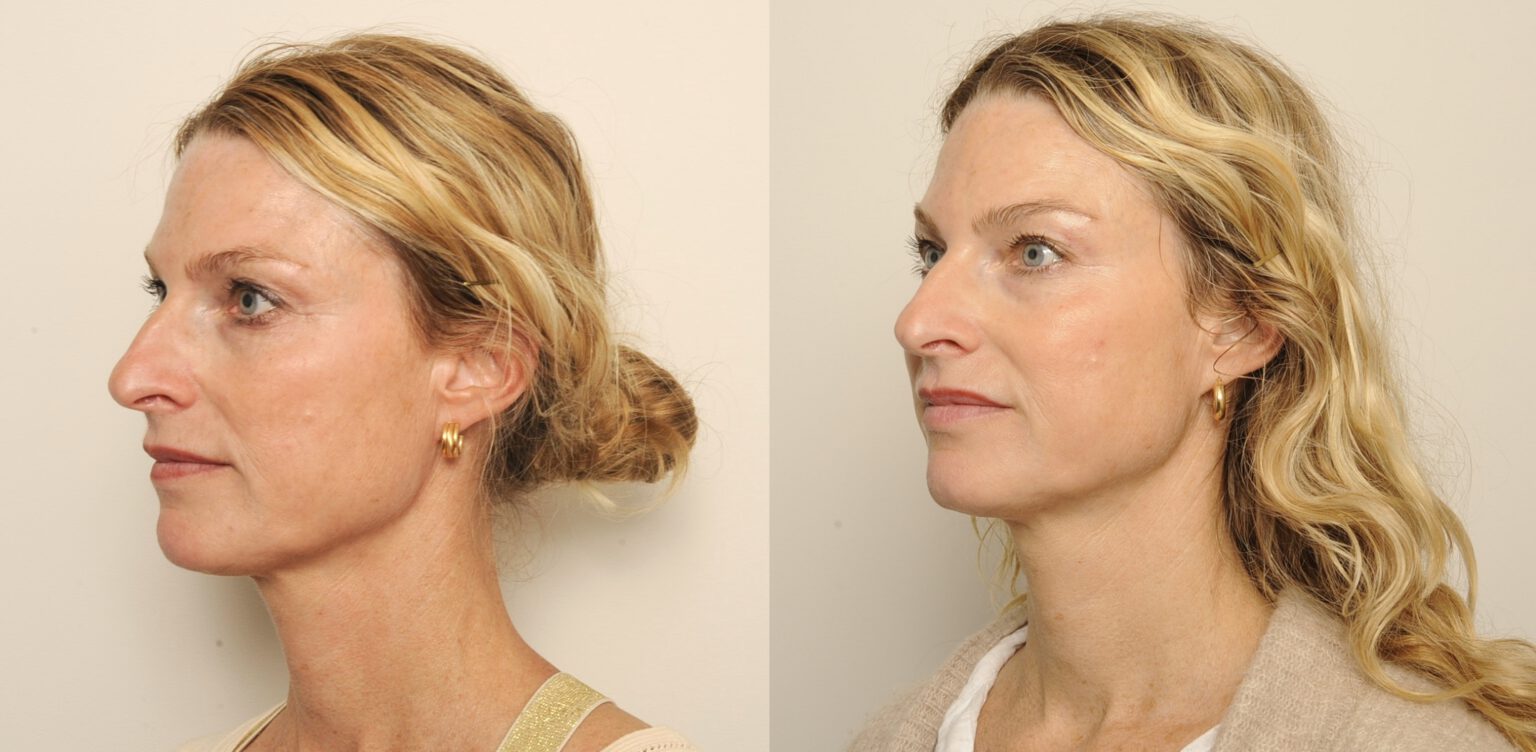 Profhilo behandeling tegen een slappere huid | Blog | ABC Clinic