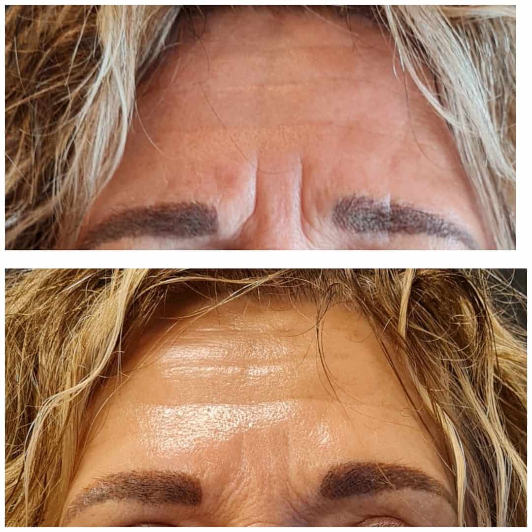 5 voordelen van vroegtijdig starten met Botox (preventie!) - ABC Clinic