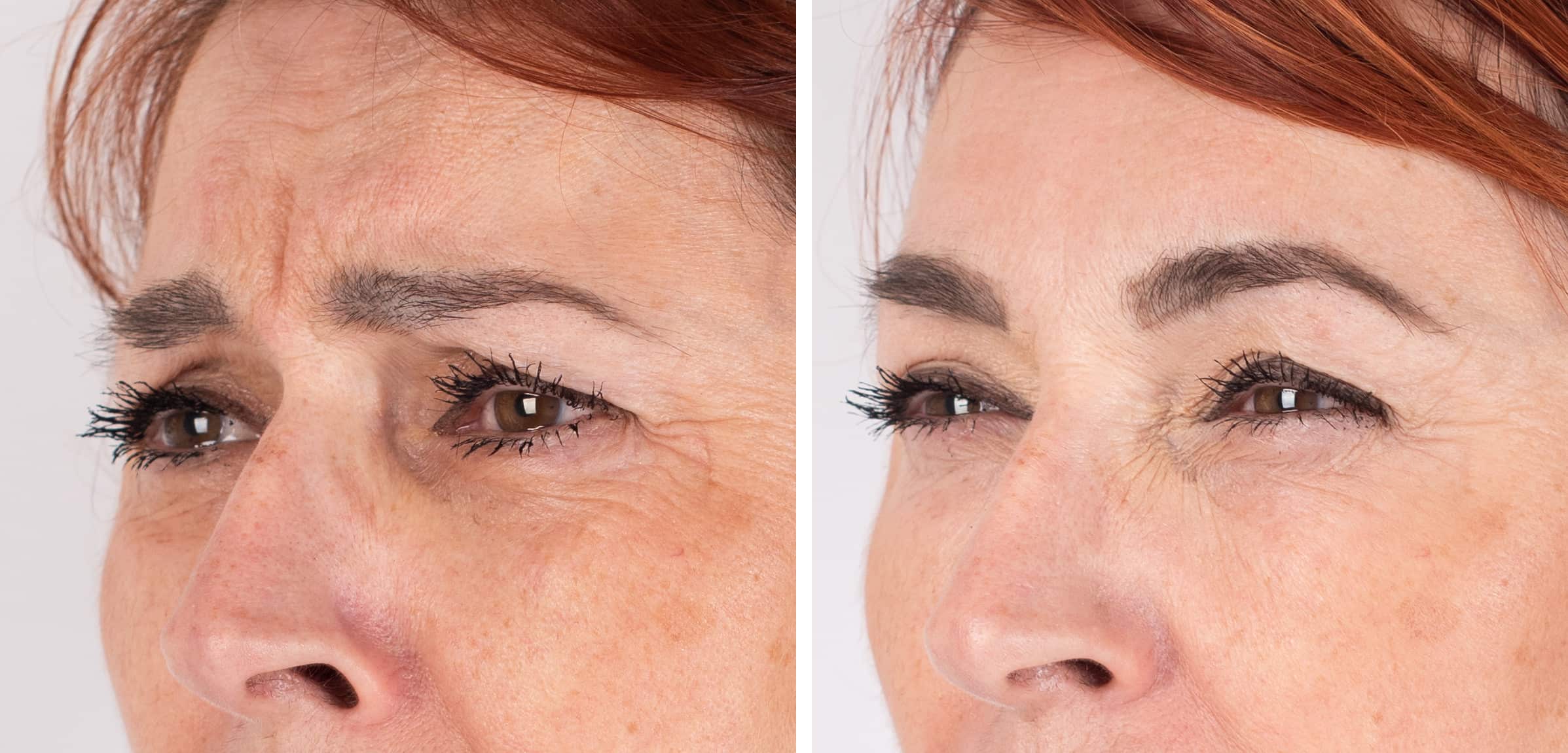 Bent u benieuwd wat Botox voor u kan doen? | ABC Clinic