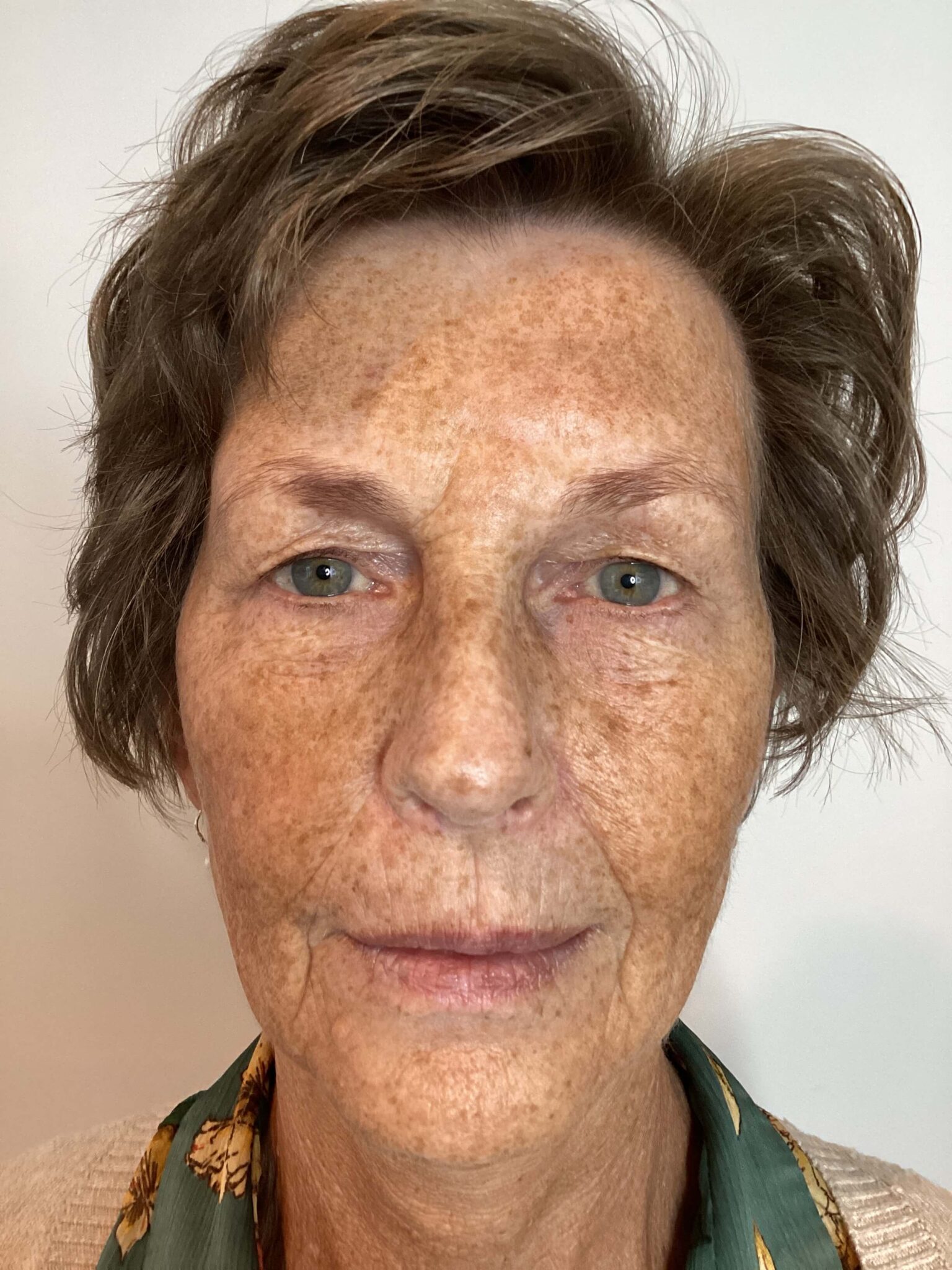 Wat kun je verwachten tijdens de eerste week na je ooglift? - ABC Clinic